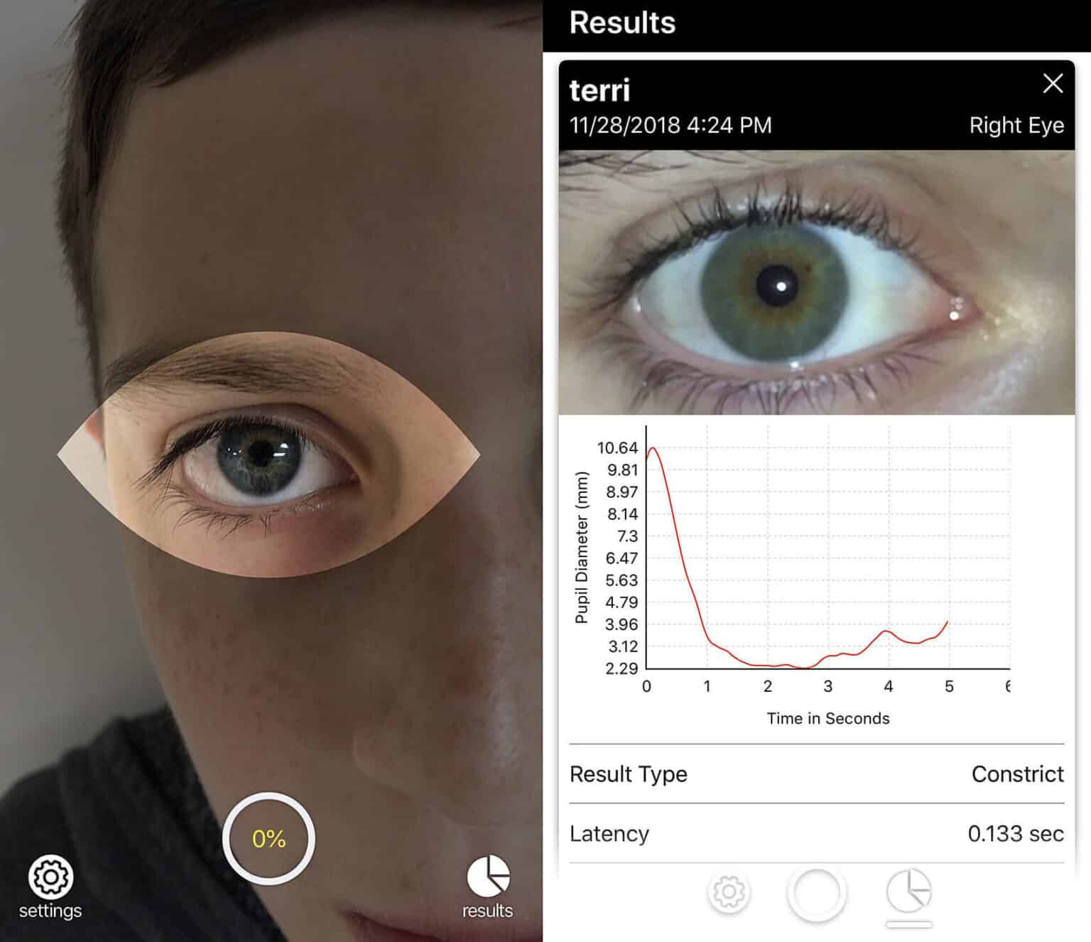 The Importance of Checking Eyes for Concussion